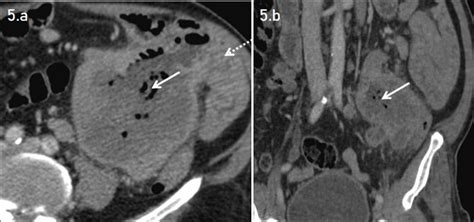 A And B 37 Year Old Case With Benign Duodenal Gist Axial A And Download Scientific Diagram
