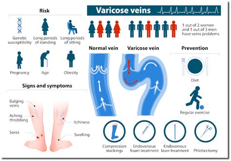 Varicose Veins Signs And Symptoms