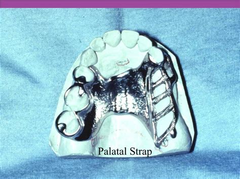 Ppt Clasp Retained Removable Partial Dentures Powerpoint Presentation