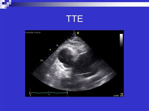 Non Invasive Conference Aortic Dissection Ppt Video Online Download