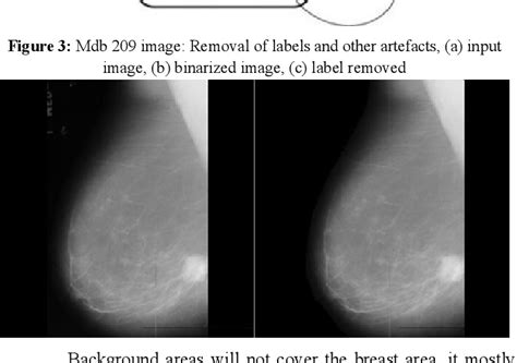 Figure 1 From Breast Cancer Classification Using Improved Fuzzy C Means Algorithm Semantic Scholar