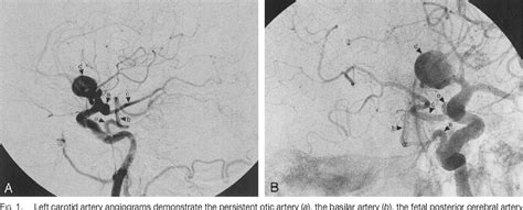 figure 1 from otic artery angiographic documentation of a persistent