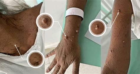 Multiple Café Au Lait Spots And Plexiform Neurofibromas In A Patient Download Scientific