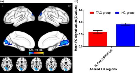 Altered Functional Connectivity Strength Of Primary Visual C Neuroreport