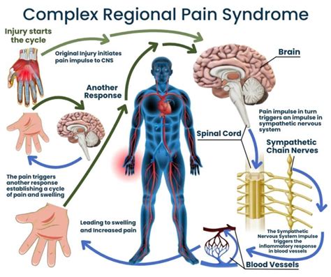 Crps Specialist Nyc And Nj Complex Regional Pain Syndrome Doctor In New