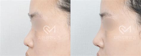 전후사진 1 페이지 나를 위해 선택한 차민성형외과