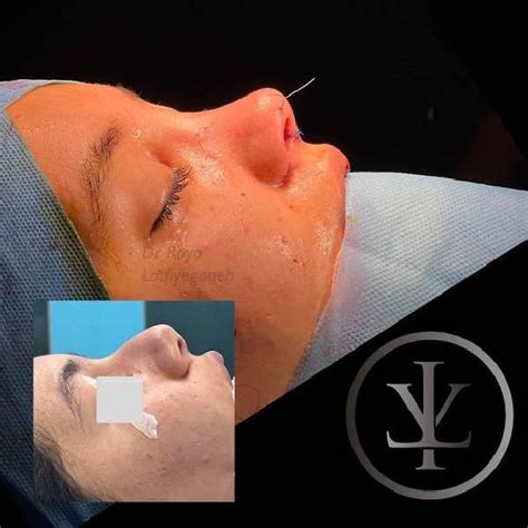 تصاویر نمونه کارهای جراحی بینی دکتر رویا لطفی یگانه