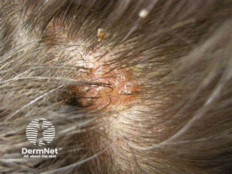 Scalp Pustules 9 Cases