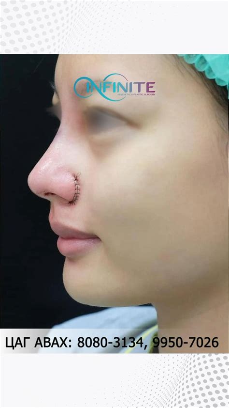 Хамрын нуруу өндөрлөж үзүүр шөнтийлгөх самсаа засах мэс засал