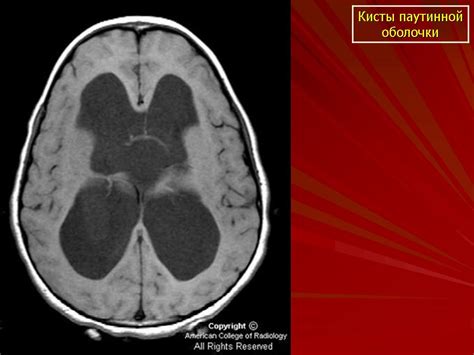 ГМ Кисты головного мозга Портал радиологов