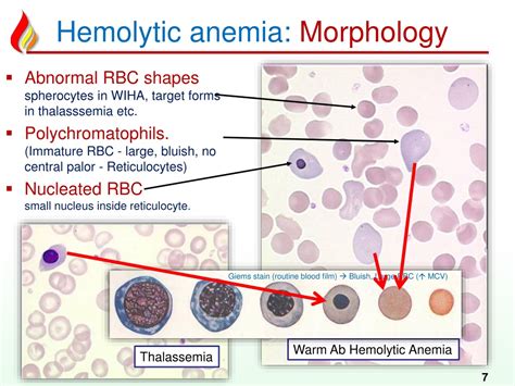 Ppt Anemia3 Hemolytic Acquired Powerpoint Presentation Free Download
