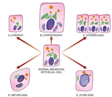 Aasstudy Hyperplasia