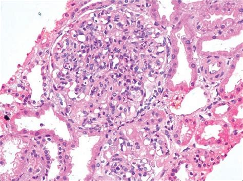 Global Endocapillary Proliferation H And E ×40 Download Scientific Diagram