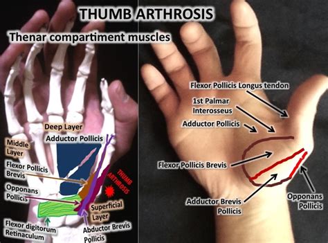 Thumb Flexion Tendon