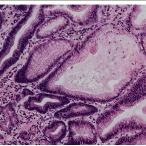 Histological Images Hande × 100 Showing Foveolar Hyperplasia With