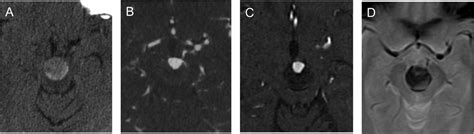 Intrasaccular Flow Disruption Web Of A Large Wide Necked Basilar Apex Aneurysm Using