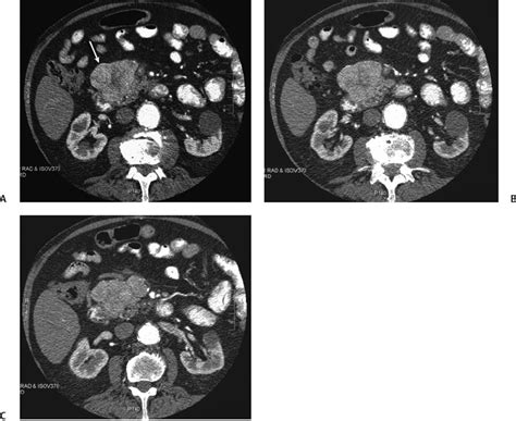 Pancreatic Carcinoma Ct