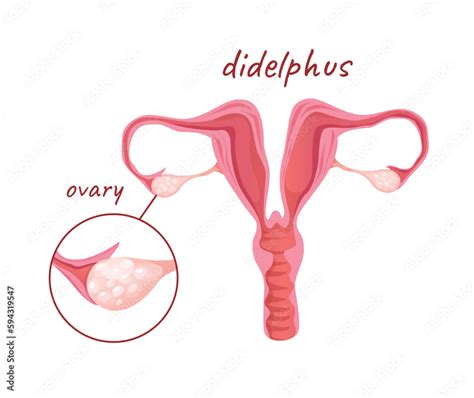 Concept Female Anatomy Uterus Didelphus The Illustration Is A Flat Vector Cartoon Style