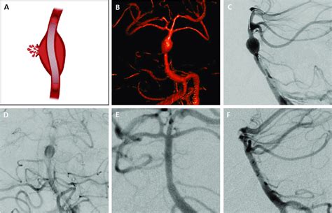 Ruptured Basilar Fusiform Aneurysm Treated With Pipeline Embolization Download Scientific