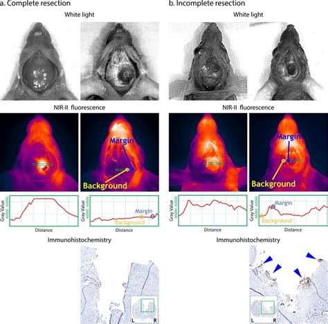 For Both Complete Resection A And Incomplete Resection B Left Hand Download Scientific