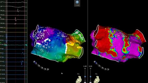 Andrea Giomi On Linkedin Atypical Atrial Flutter Around Right