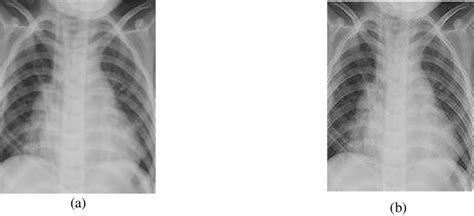 Figure 1 From Pneumonia Classification Based On Glcm Features Extraction Using K Nearest