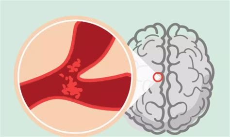 Brain Stimulation Promising Treatment For Patients With Acute Ischemic Stroke Jama