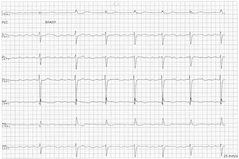 Does Atrial Flutter Always Turn Into Afib Flutter Grosepi