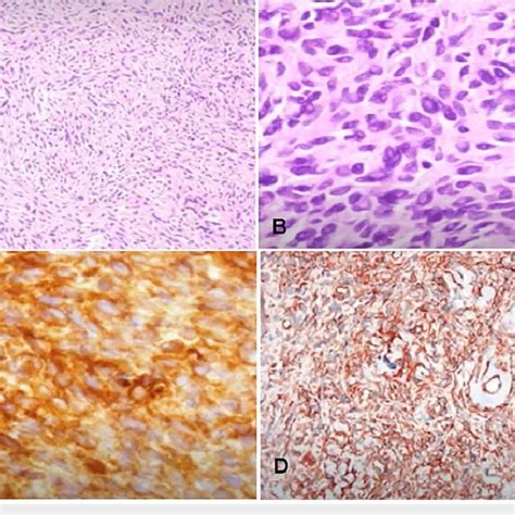 Patternless Spindle Tumor Cells Mixed With Varying Amounts Of Collagen Download Scientific
