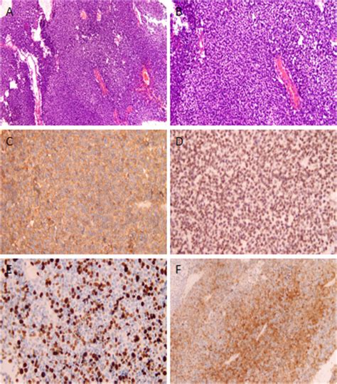 Primary Primitive Neuroectodermal Tumor Of The Cervix Confirmed With Molecular Analysis In A