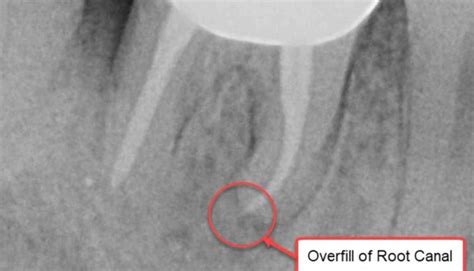 what happens if root canal fails dental news network