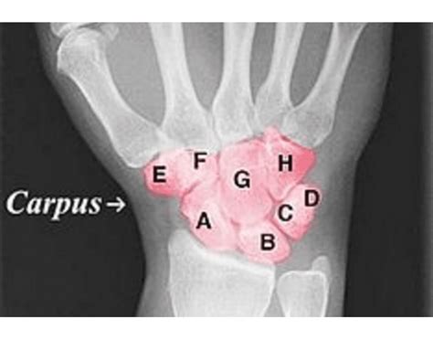 Carpal Bone Labeling Quiz