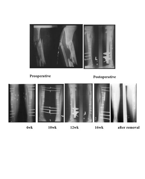 Minimal Fixations For Treatment Of Closed Segmental Fractures Of Tibial Shaft In Adults