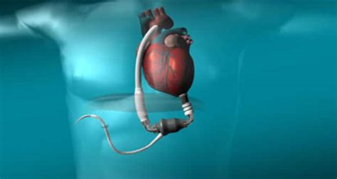 Heartmate Ii A New Hope For Terminal Heart Patients
