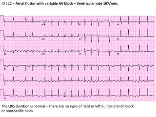 Ecg 10 Id122 Atrial Flutter Ppt