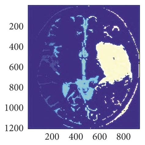 Tumor In Brain Region Segmentation In A Sample Tumor Brain Mri Image Download Scientific