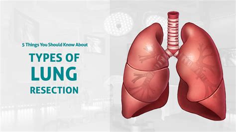 What Is A Lung Resection At Mabel Singer Blog