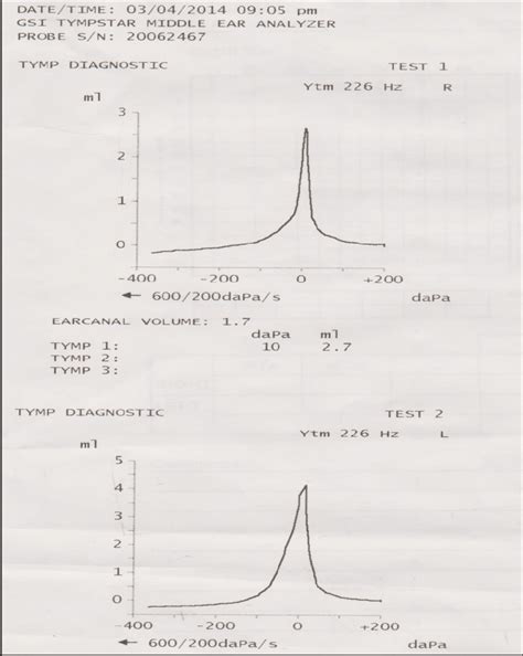 Tympanogram Bilateral Type A Download Scientific Diagram