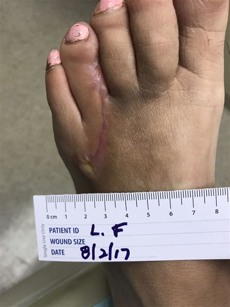 Patient Stories Orbactiv® Oritavancin For Injection