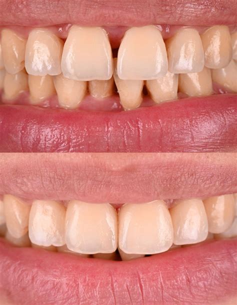 João Gil Agostinho On Linkedin Black Triangule Restauration Using Bioclear Matrix