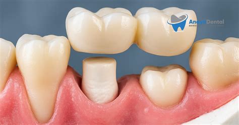 Section Bridge Ada Codes Description Coverage And Costs Anaya Dental