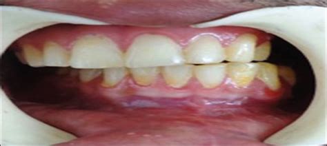 Maxillary Palatal Ramp Prosthesis A Prosthodontic Solution