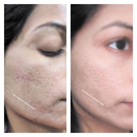 Prp Skin Treatment In Mumbai Vampire Facial Vampire Facelift