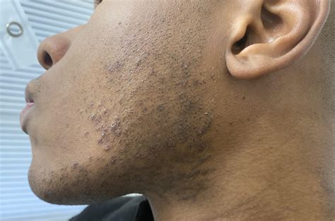 Hyperpigmentation Face