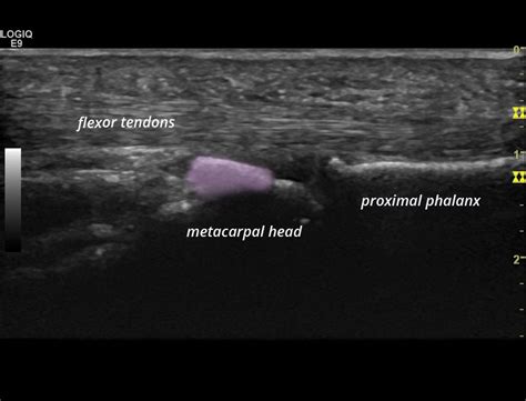 [cppd] Mcp Joints Arthropathy Sonotool®