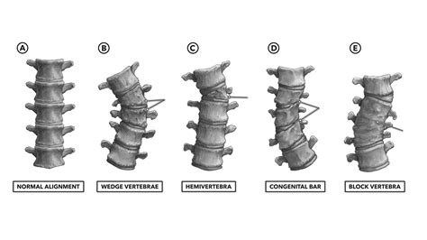 Wedge In Spine
