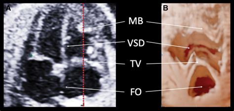 Application Of 3 Dimensional Fetal Echocardiography In The Detection Of