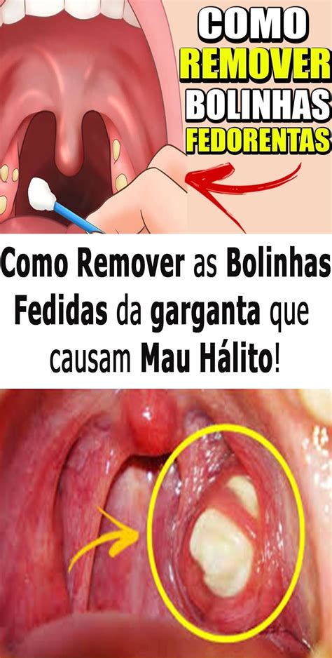 Como Remover Bolinhas De Mau Cheiro Da Garganta E Gosto De Podre Na Boca 90e Remover Canal