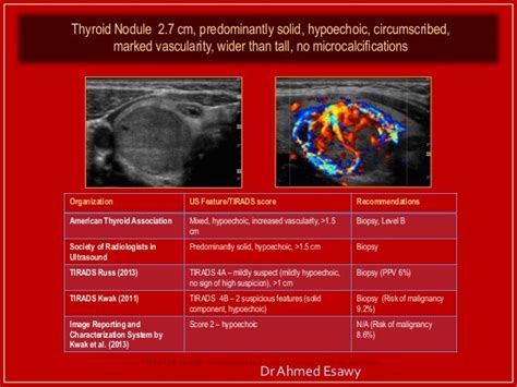 Tirads Thyroid Nodule Imaging Reporting And Data System Dr Ahmed E…