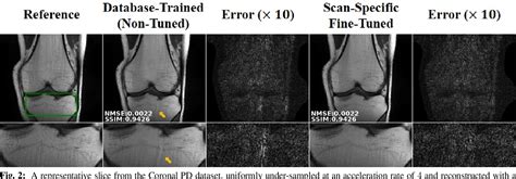 figure 2 from high fidelity accelerated mri reconstruction by scan